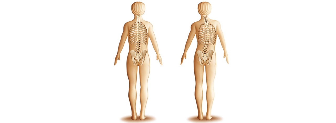 Scoliosis Other Spinal Deformities - Dr. Vaibhav Jain
